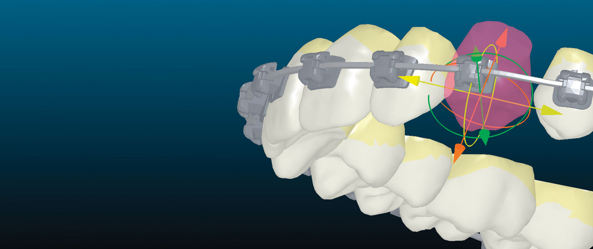 Insignia moderne und digitalen Kieferorthopädie